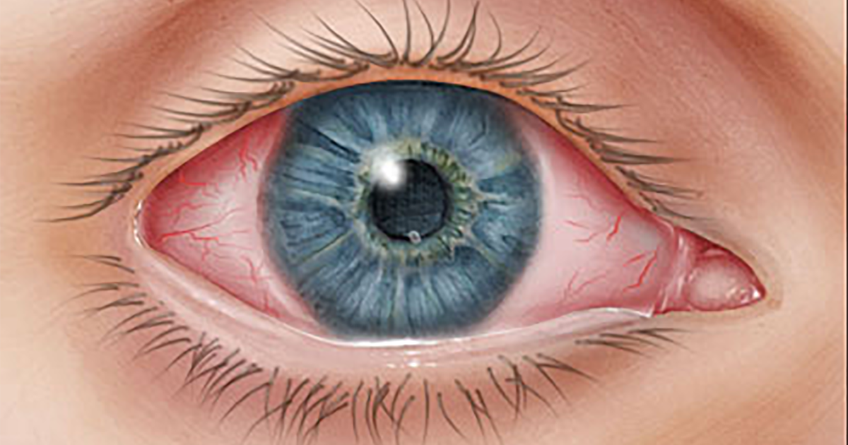 Conjuntivitis: Causas y tratamiento - Pediatría del Noroeste
